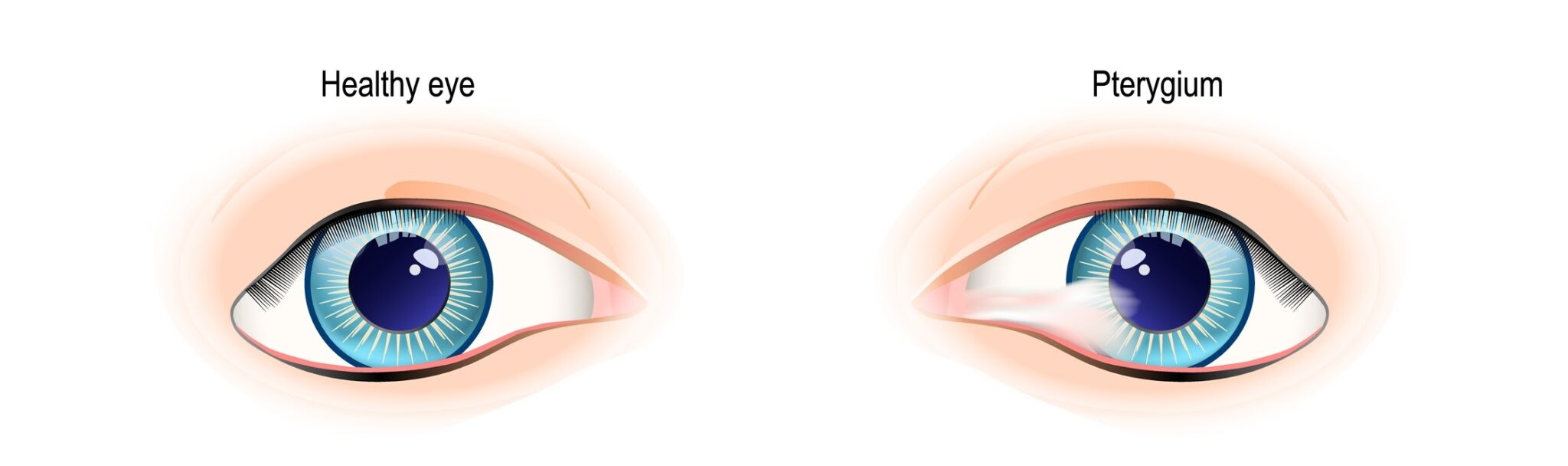 What is a Pterygium, and Can You Treat One? | Evergreen Eye Center