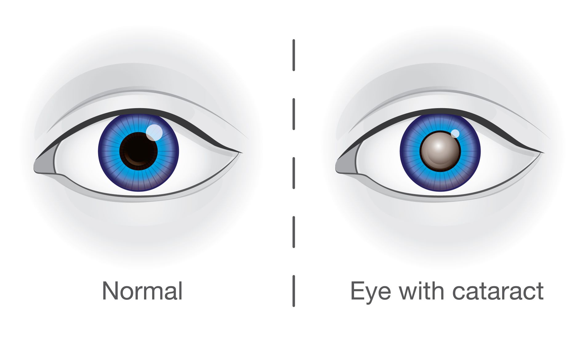 Cataracts Seattle | Cataract Surgery Tacoma | Evergreen Eye