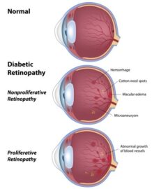 What is Diabetic Retinopathy? | Evergreen Eye Center